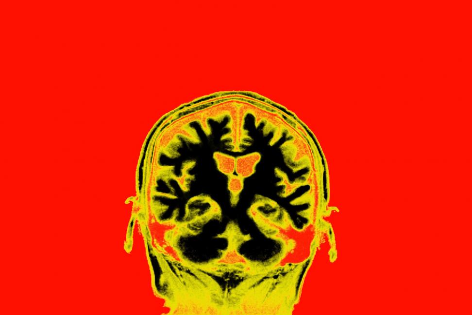 This is your brain under anesthesia | Harvard-MIT Health Sciences and ...